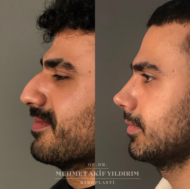 Rhinoplasty Before and After in Turkey - Photo Album By Dr. Mehmet Akif ...